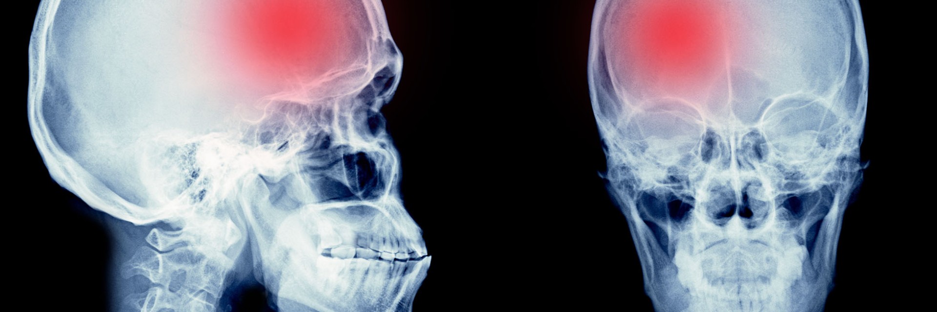 Utmost severity traumatic brain injury cases: Is the claimant likely to ...